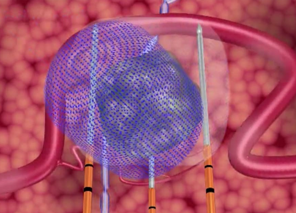 NanoKnife - Prof. Dr. Volkan Tuğcu